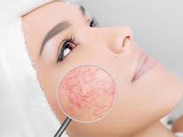 How To Treat Red Cheeks This Spring - Fashion.ie 2023